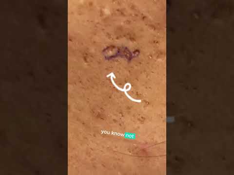 SCAR REVISION ON ACNE SCARS - DR. TANVEER JANJUA - NEW JERSEY