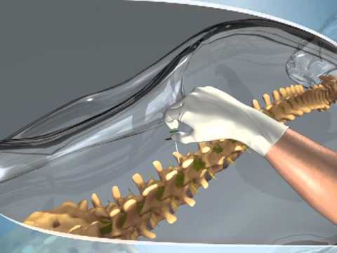 What to expect during a Myelogram at CDI