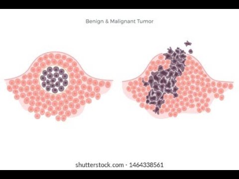 What are Malignant Tumors/ Understanding Malignant Tumor; Part 2