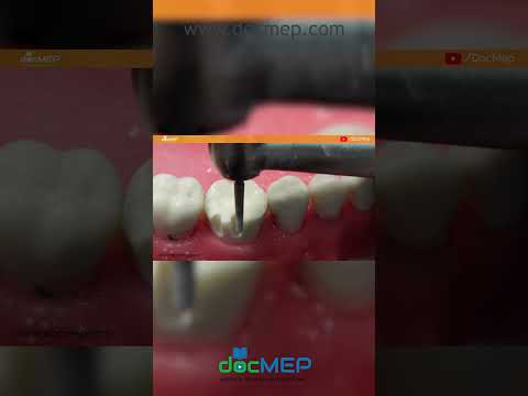 Tooth Preparation for All-ceramic Posterior Crown