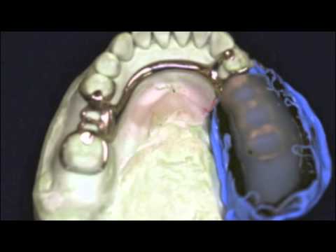 Altered Cast in Removable Partial Dentures