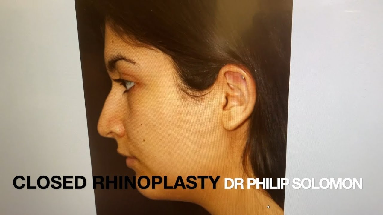 BEFORE AND AFTER RHINOPLASTY, SPLINT REMOVAL WITH DR. PHILIP SOLOMON