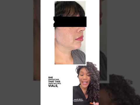 Kybella injections before and after, fat dissolving double chin, nonsurgical permanent fat removal