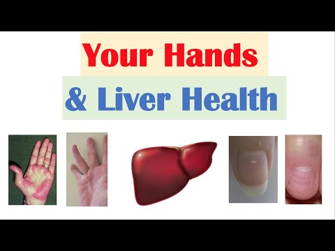 Your Hands & Liver Health | What Your Hands Can Tell You About Your Liver Health