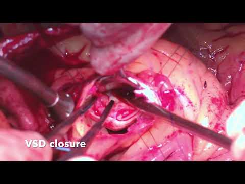 Repair of Ruptured Sinus of Valsalva Aneurysm, Ventricular Septal Defect, and Mitral Valve
