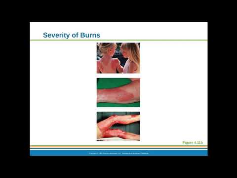 4 4 Homeostatic Imbalances of the Skin