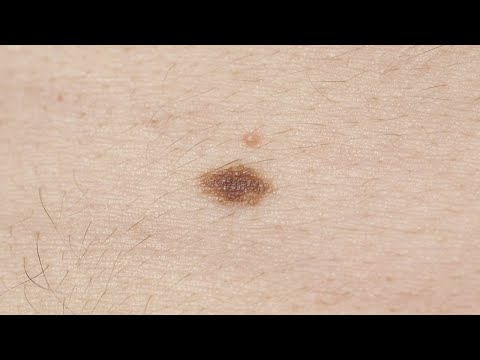 Melanoma symptoms: How to spot signs, and when to see a doctor