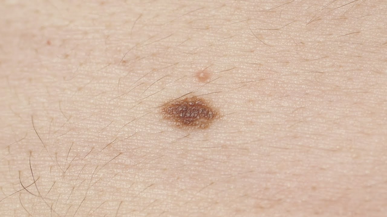 Melanoma symptoms: How to spot signs, and when to see a doctor