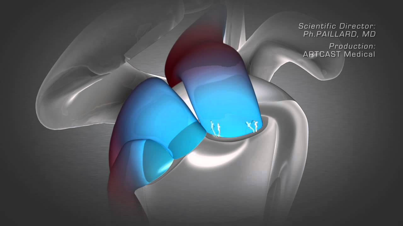 Shoulder Arthroscopy - Rotator Cuff Repair