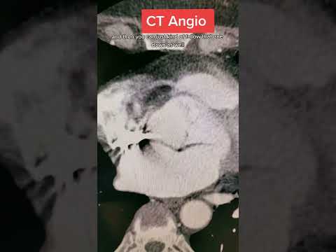 Coronary CT scan. CCTA
