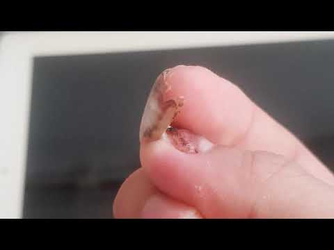 [ASMR] Viet Nam Case: Stubbed Toe Nail Falled Off - part2