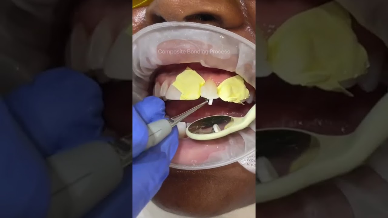 Composite bonding process 🤍