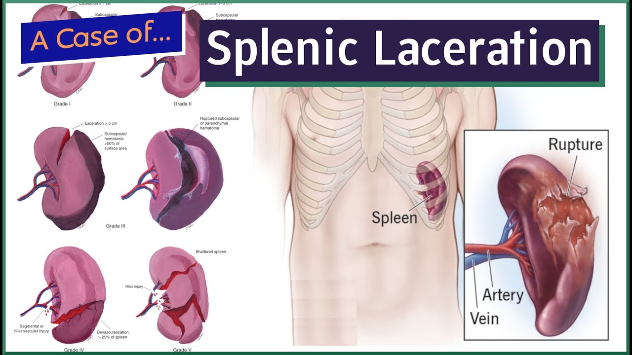 Splenic Laceration
