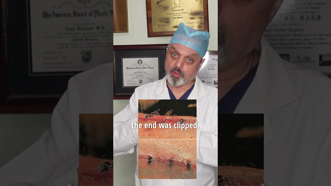 Can Army Ants Really Suture Wounds? #shorts  #sushrutha