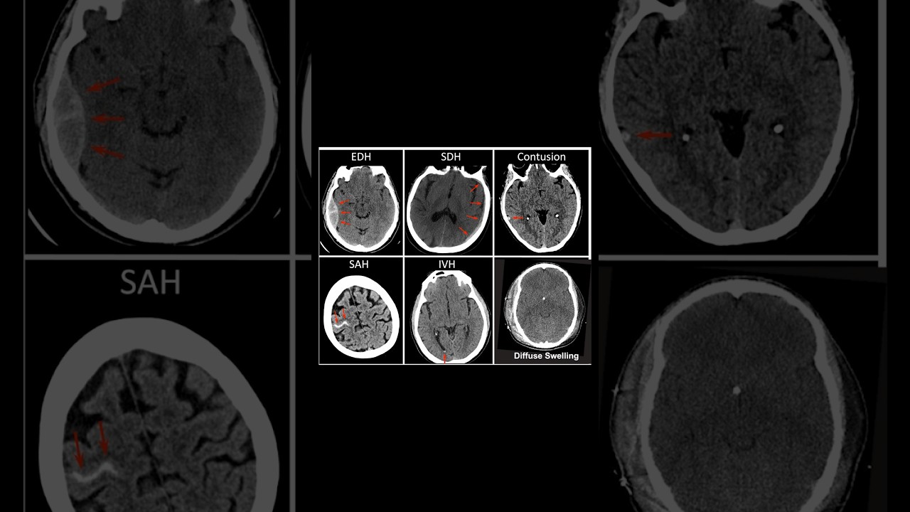 Managing a severe head injury