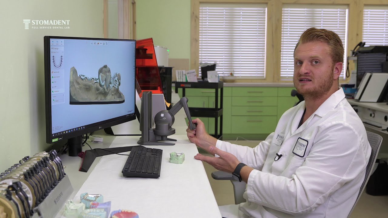 Digital Partial Dentures - Acetal Resin, Titanium & Wironium Metal Framework at Stomadent Dental Lab