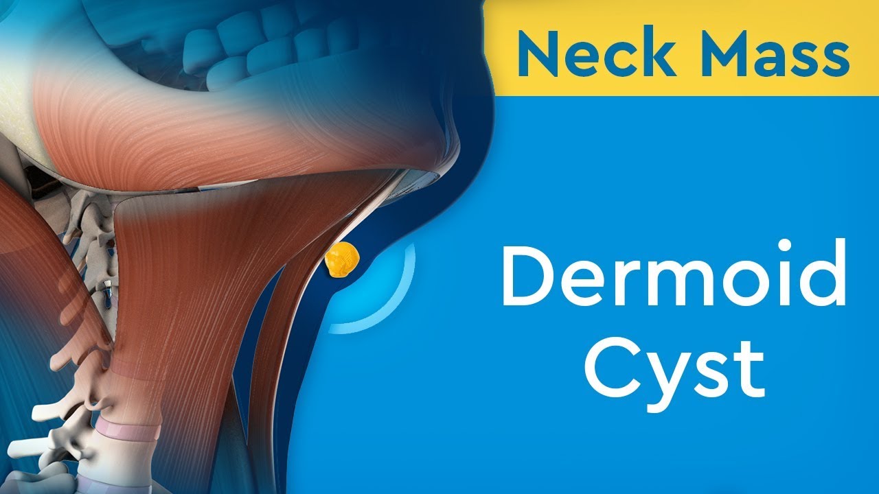 Neck Mass: Dermoid Cyst