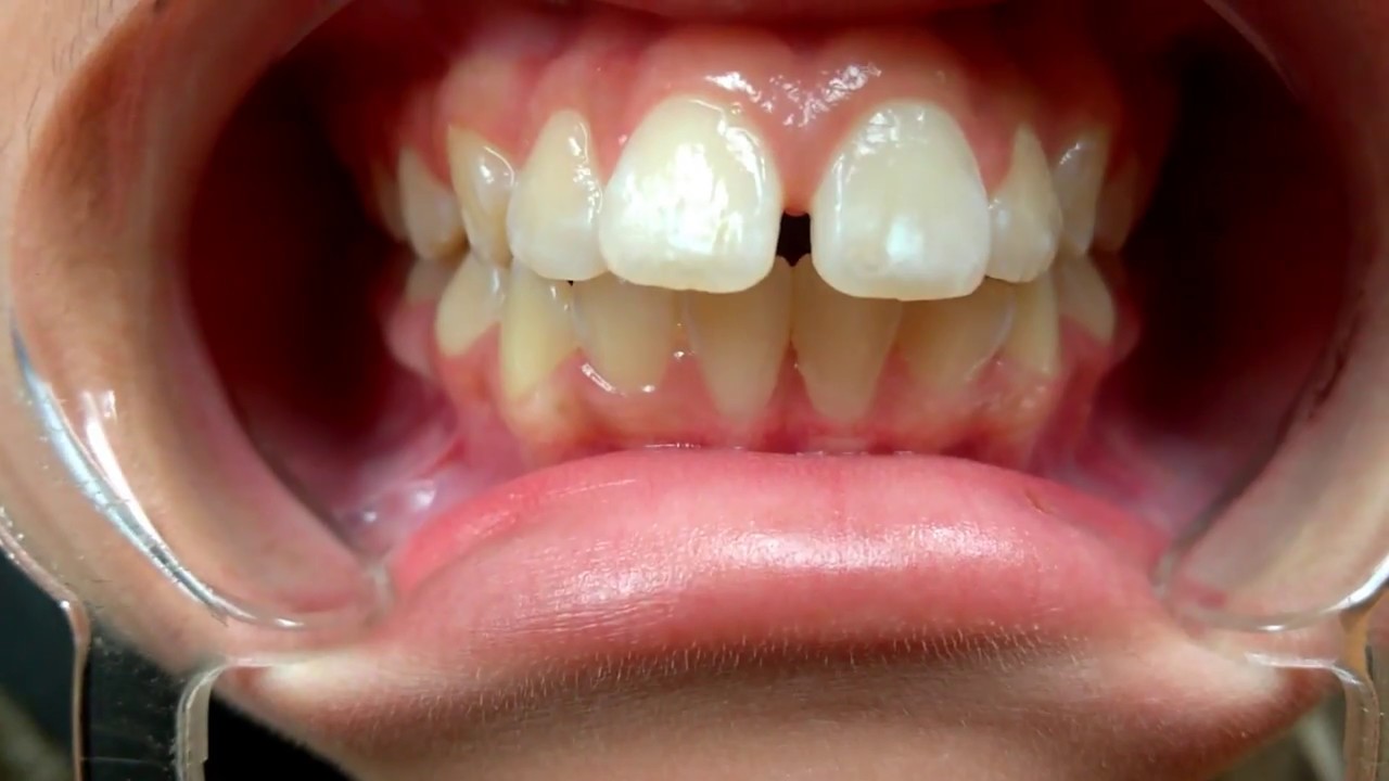 Tongue Thrust Evaluation