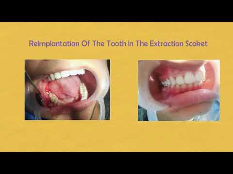 Intentional Reimplantation : A Long lost Forgotten Technique