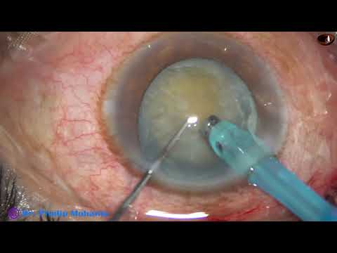 A Non-intumescent white senile cataract : Pradip Mohanta, 10/8/2019
