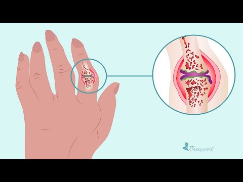Inflammatory Arthritides