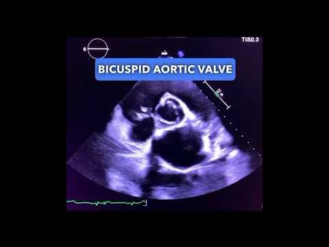 What does a Bicuspid Aortic Valve look like? #echocardiography #cardiology #echocardiogram