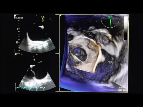 Atria & Abnormalities – Critical Care Northampton