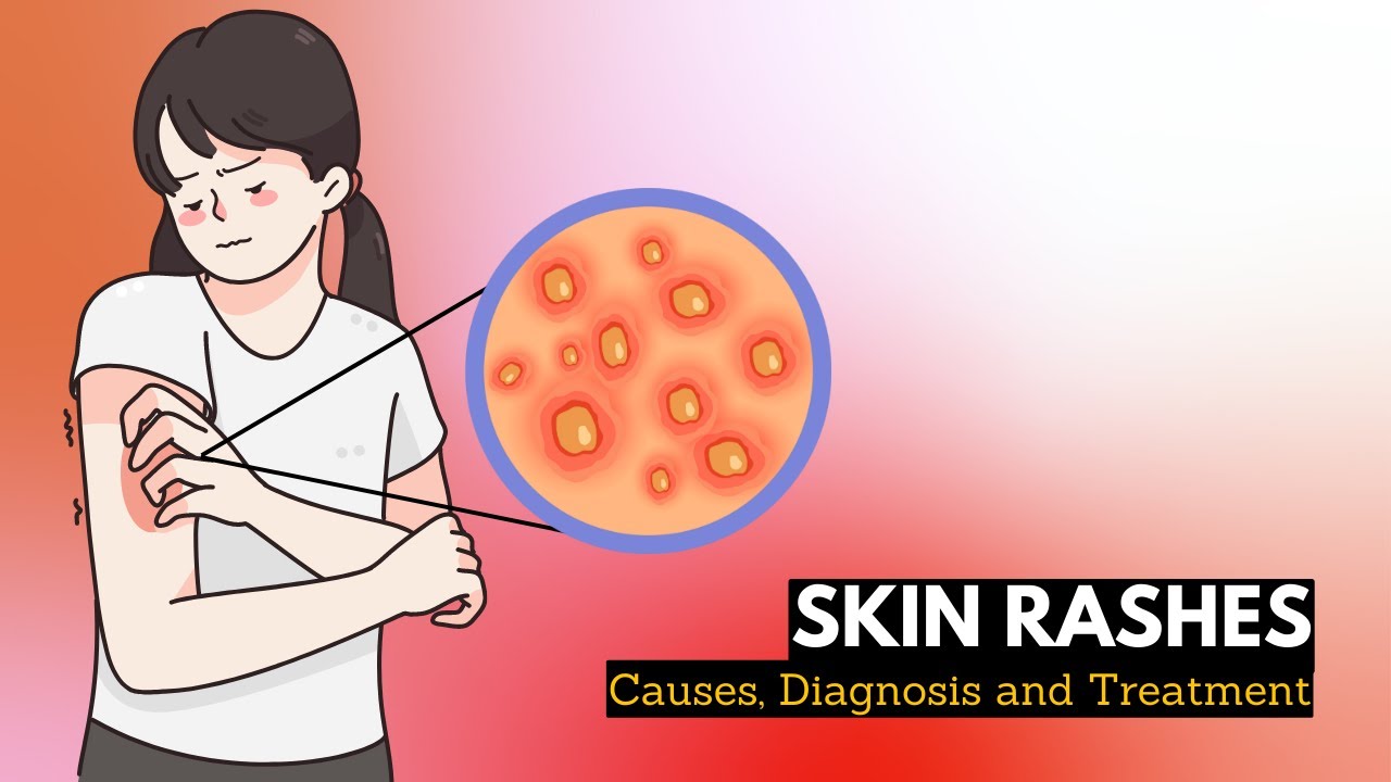Skin Rash, Causes, Signs and Symptoms, Diagnosis and Treatment.