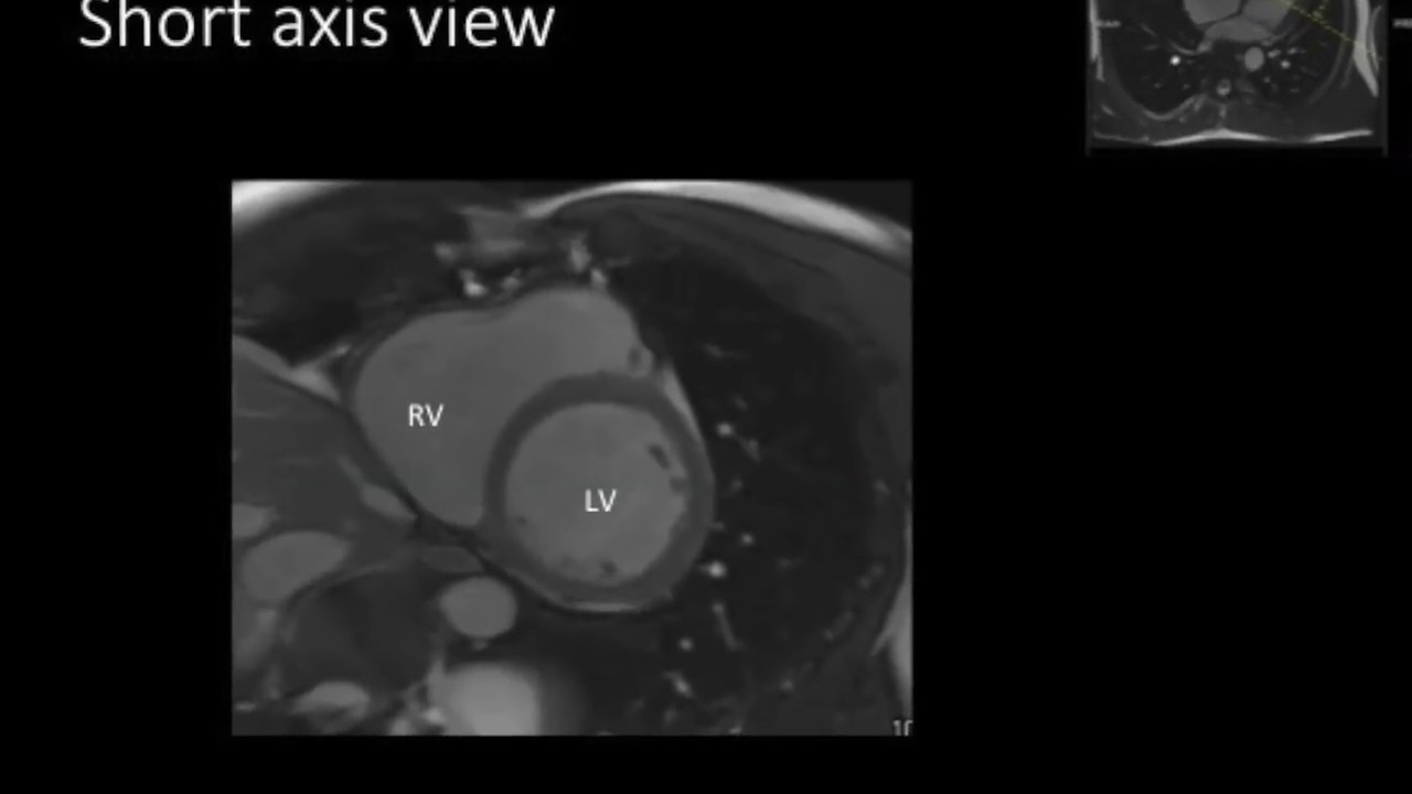 TMT: Cardiac MR by Dr Avanti Gulhane: Anatomy Basics