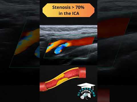 Severe Carotid Artery Stenosis Ultrasound Findings Explained #ultrasound #ultrasoundcases