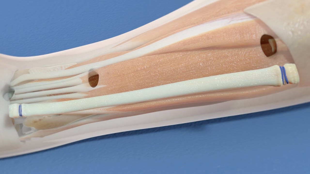 Tommy John Surgery (UCL Reconstruction) (3D Animation)