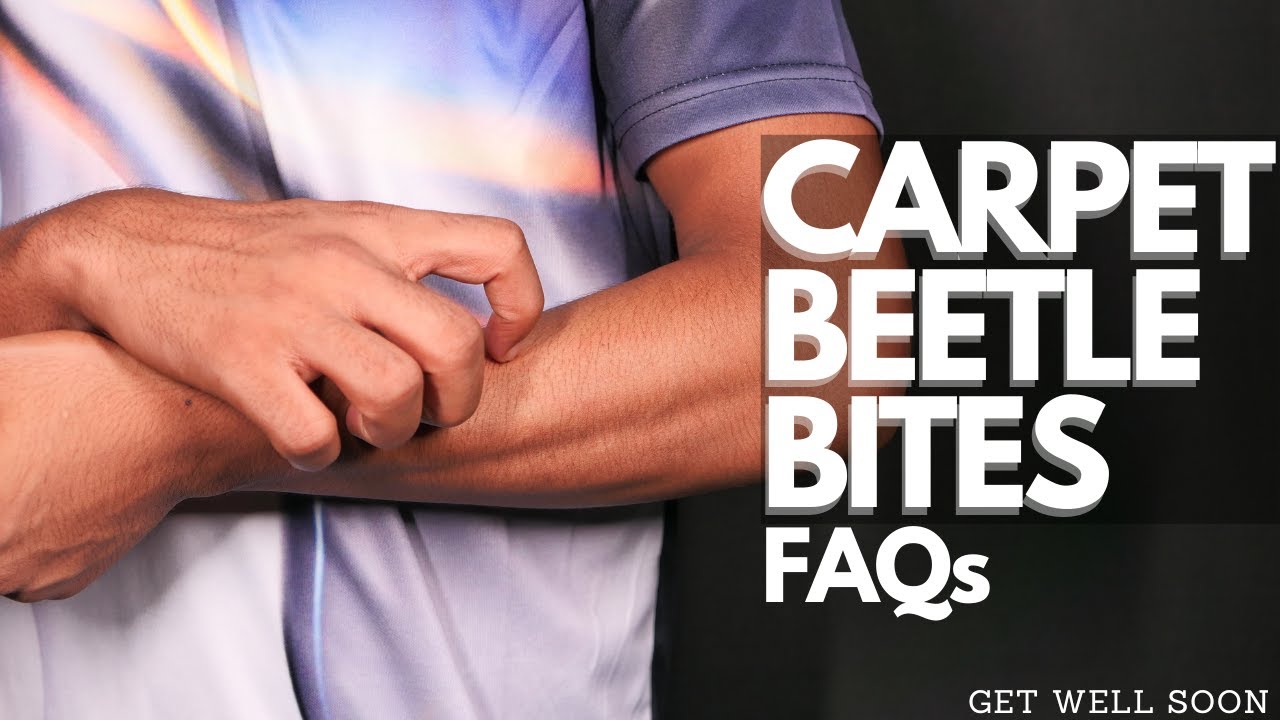 Carpet Beetle Bites FAQs