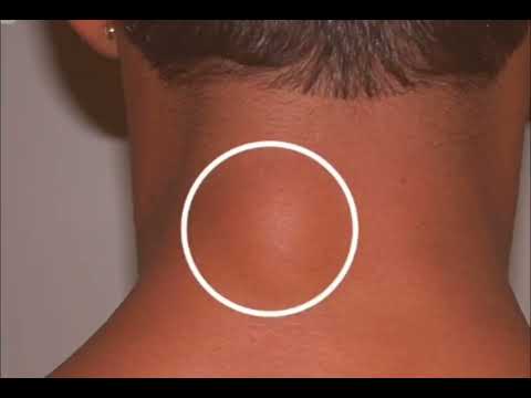 Lipoma : Description and Treatment.