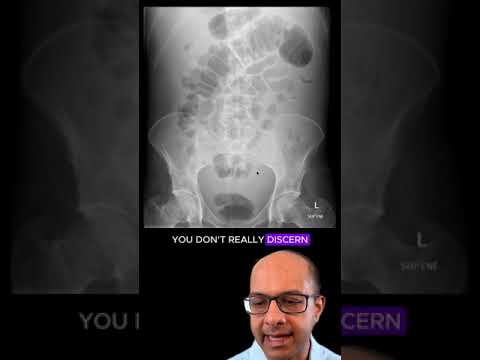 Ascites on abdominal x-ray #radiology #medicalstudent #medicine
