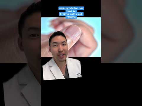 Causes for Vertical Nail Ridges and Lines