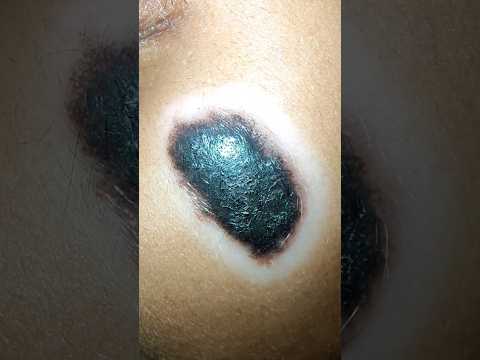 Halo nevus 😱 #skincare #shortsfeed #viral #doctorskin