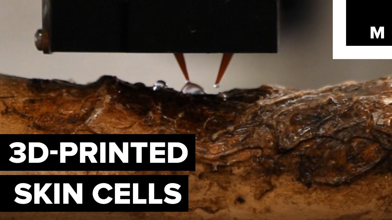 3D Printing Skin Cells on Burn Wounds