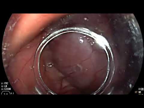 Demonstration of feasibility and technique of transesophageal endoscopic epicardial access