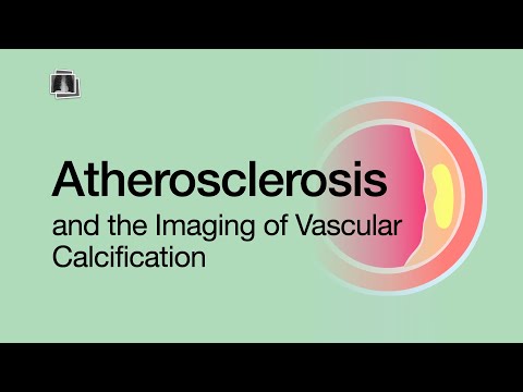 Atherosclerosis & the Imaging of Vascular Calcification