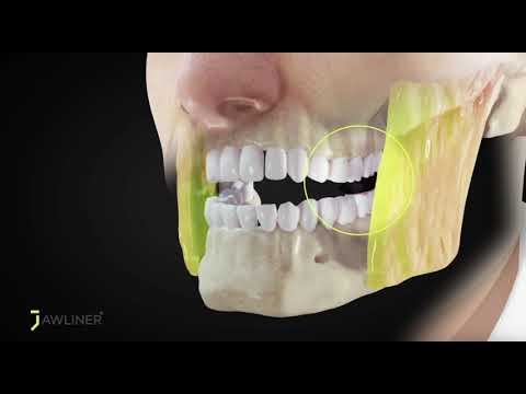 JAWLINER Jaw muscle workout - how it works - mewing