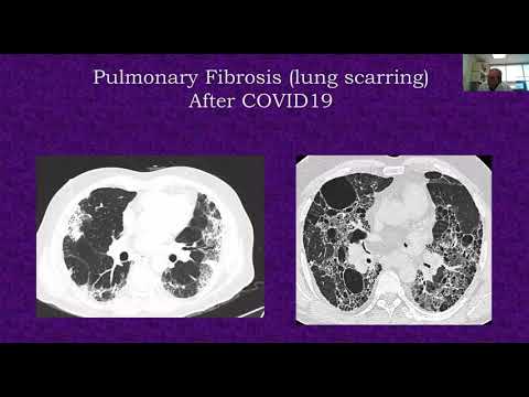 Post-COVID-19 Symptoms and Syndromes