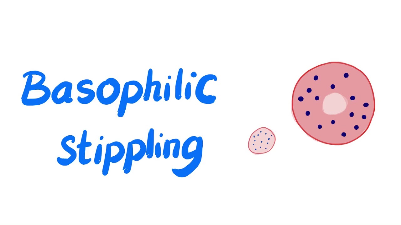Basophilic Stippling of RBCs - Lead Poisoning - Microscopic Finding - Hematology Labs