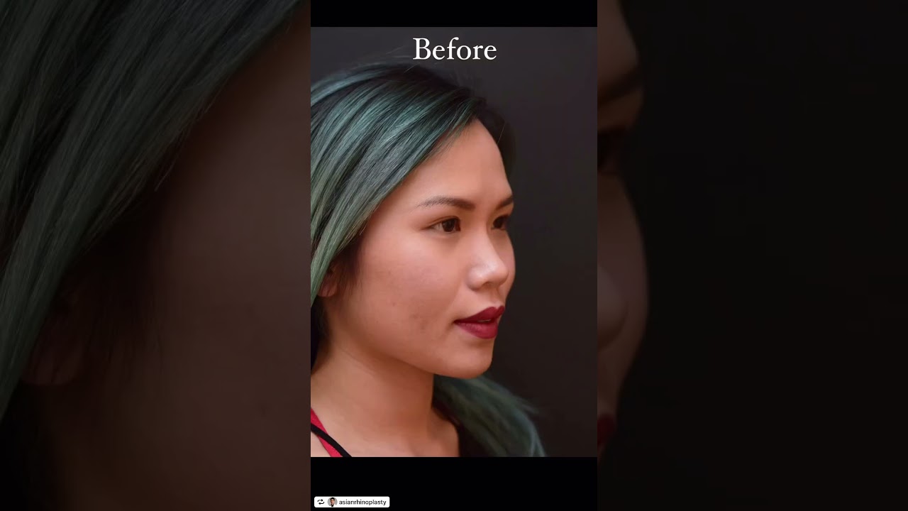 Asian Eyelid Surgery (Double Eyelid) #asian #eyelidsurgery #plasticsurgery #beforeandafter