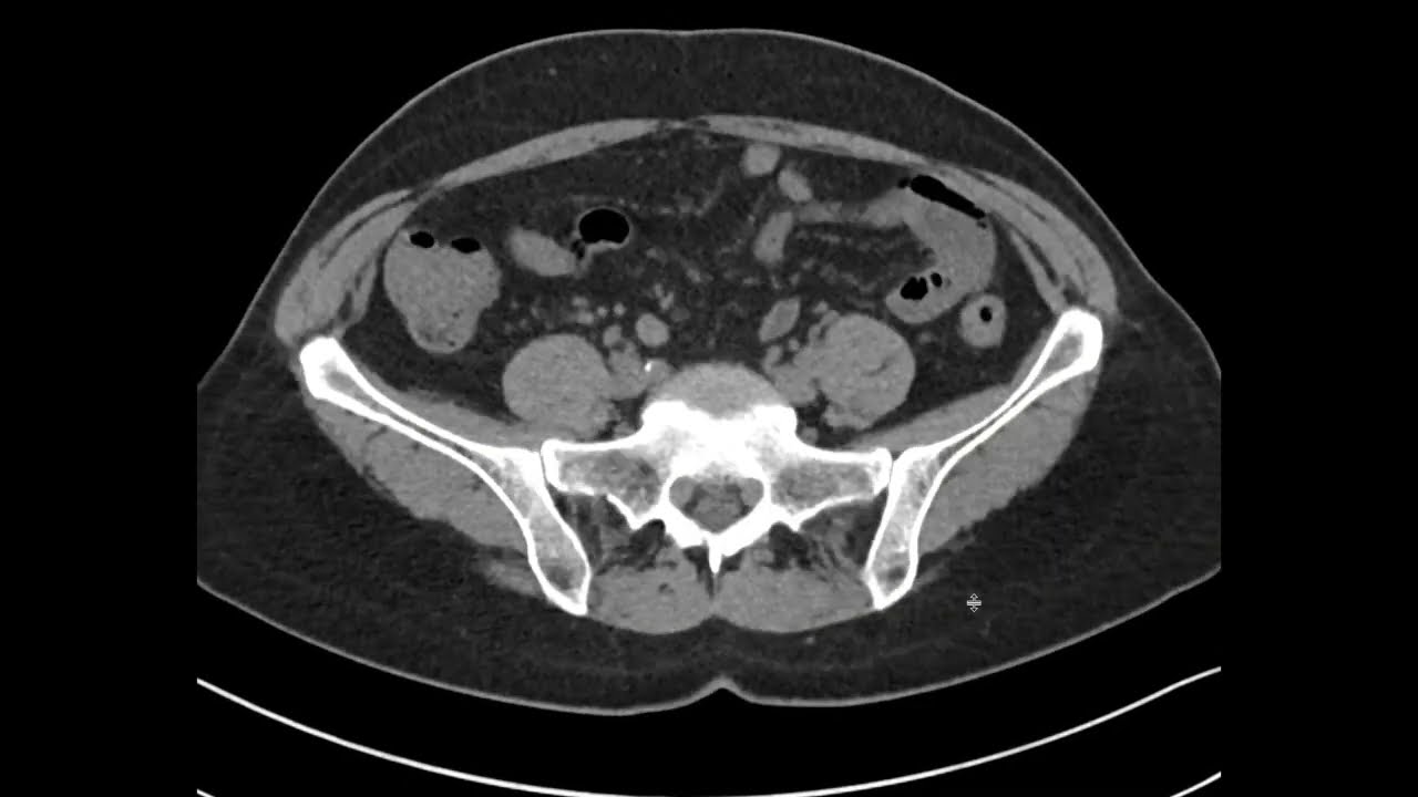Abdominal CT protocol  - noncontrast