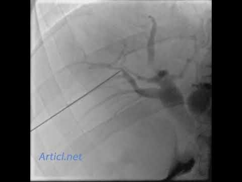 Percutaneous Biliary access under Fluoroscopy
