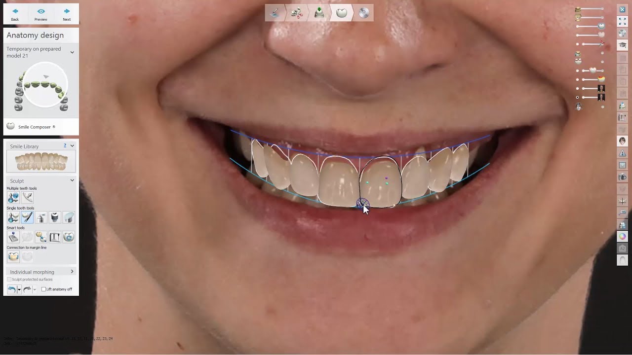 3Shape Smile Design