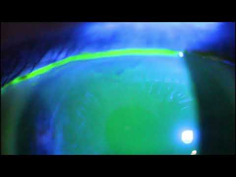 EBMD Map Dot Cornea Dystrophy with NaFl Fluorescein Dye