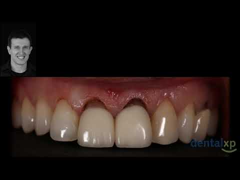 Restoring the Pink and White Esthetics Clinical Case Presentation