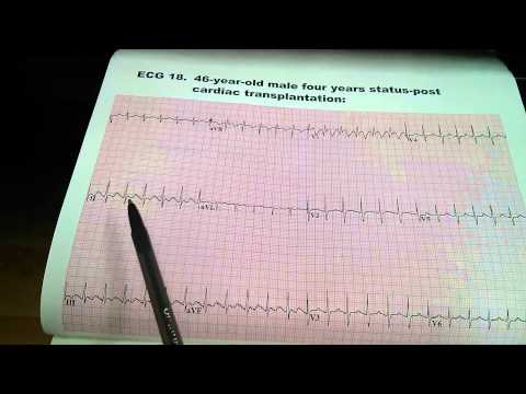 EKG ECG electrocardiogram Cardiologist Cardiology www.drbenzur.com