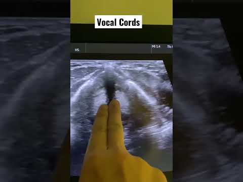 Finding vocal cords